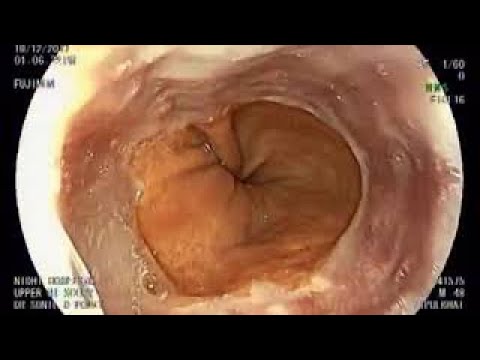 GERD in Upper GI Endoscopy by Dr Sunil Popat Nidhi Hospital