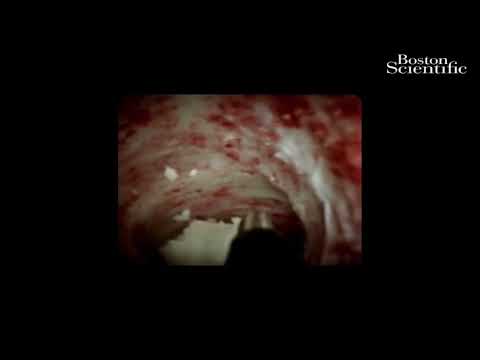 Spyglass Cholangioscopy with EHL for Pancreatic Stone Fragmentation | Advanced Endoscopy Case