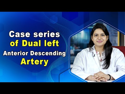 Case series of Dual left anterior descending artery