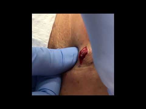 Epidermal Inclusion Cyst