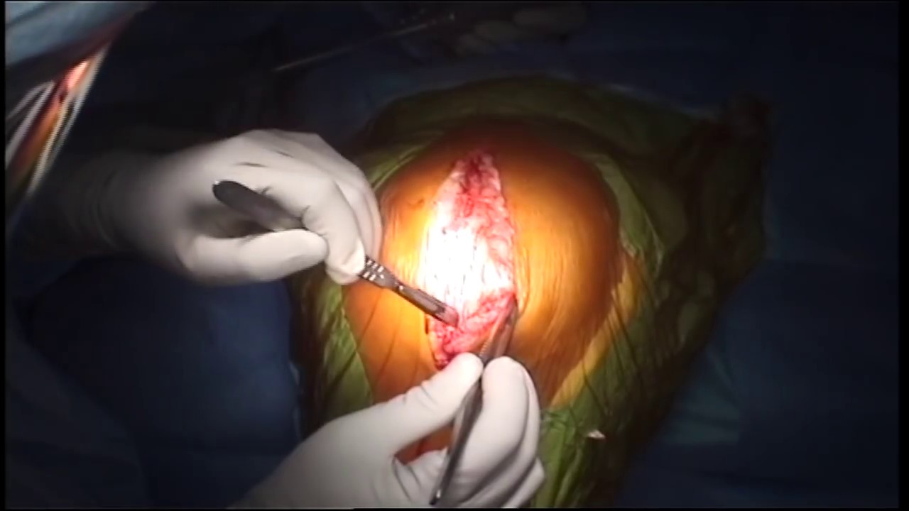 Revision Total Knee Replacement | Revision Knee Arthroplasty | Dr Munjed Al Muderis Demonstrates.