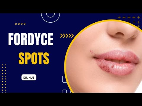 Exam High Yield : Fordyce Spots / Fordyce Granules – Dr Hub