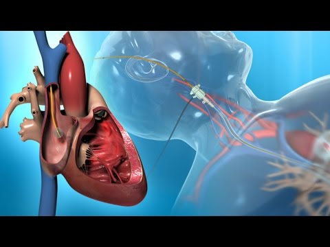 Right Heart Catheter for the Diagnosis of PAH