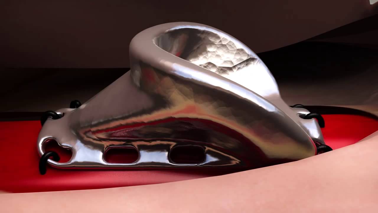 VWING Procedure 3D Animation