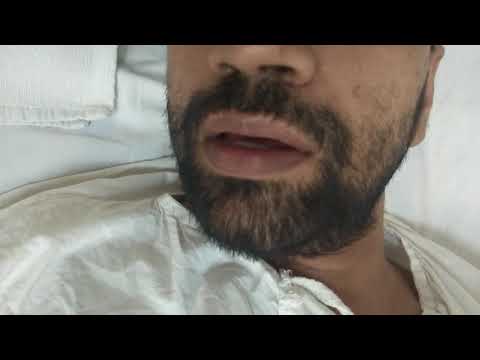 Scanning speech in cerebellar lesion
