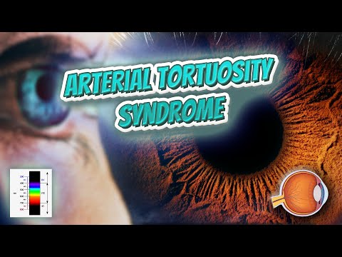 Arterial tortuosity syndrome - Your EYEBALLS - EYNTK 👁️💉😳💊🔊💯✅