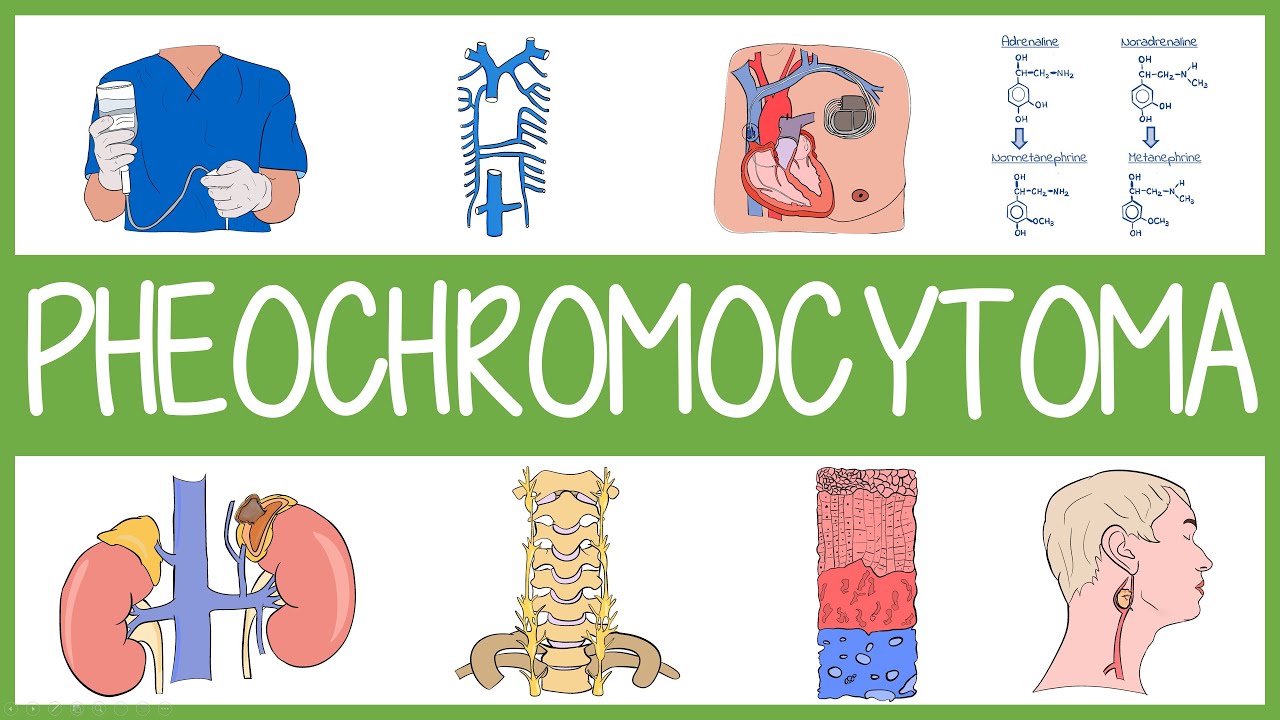 Pheochromocytoma in 3 Minutes