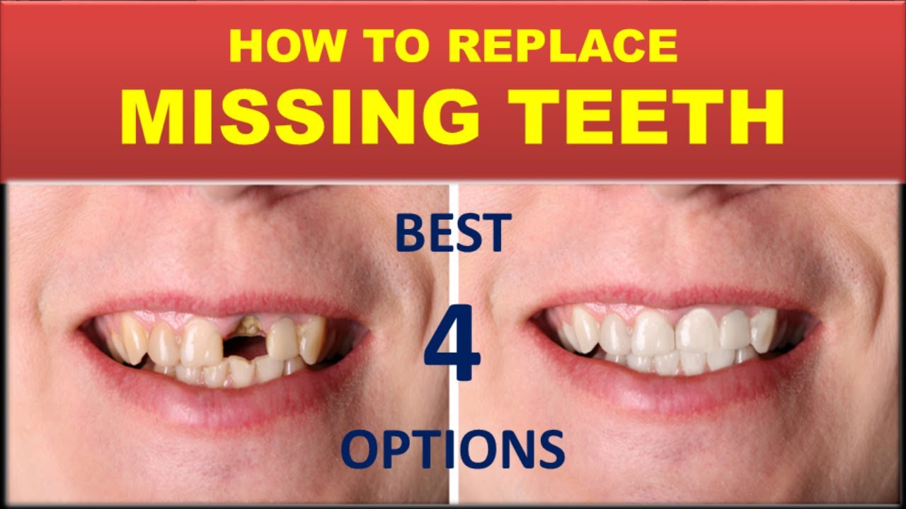 How to replace missing teeth | teeth replacement options by Dr Rohan virani- cosmetic dentist