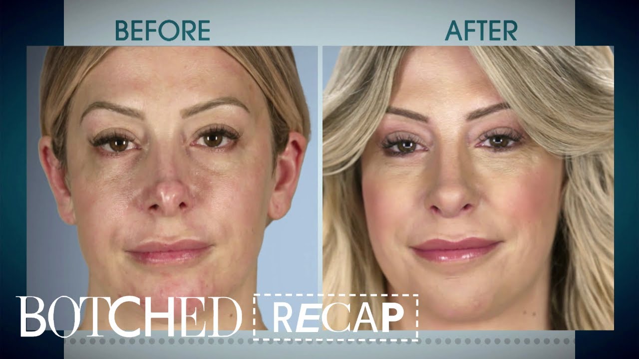 Dinosaur Nose Needs Fixing | Botched Recap (S5 Ep14) | E!