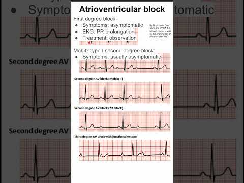 Atrioventricular block