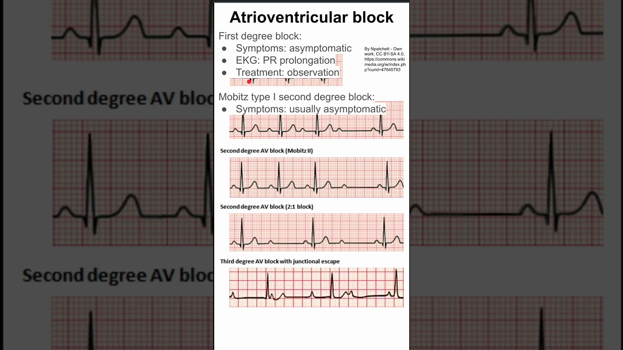 Atrioventricular block