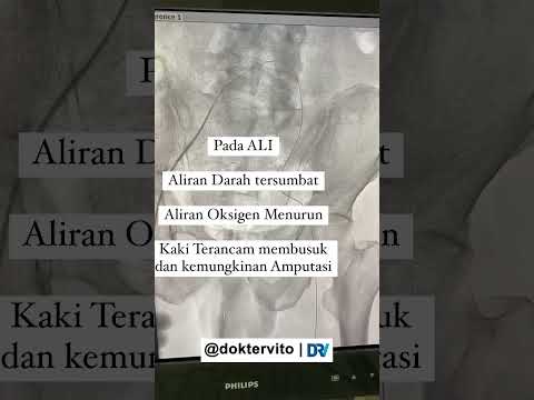 Sumbatan Pembuluh Darah Kaki #Jantung #pembuluhdarah #doktervito #varises