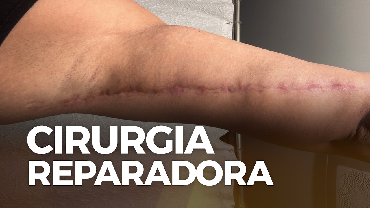 Quando e como fazer a cirurgia de remoção de pele após a bariátrica? | Dr André Araujo
