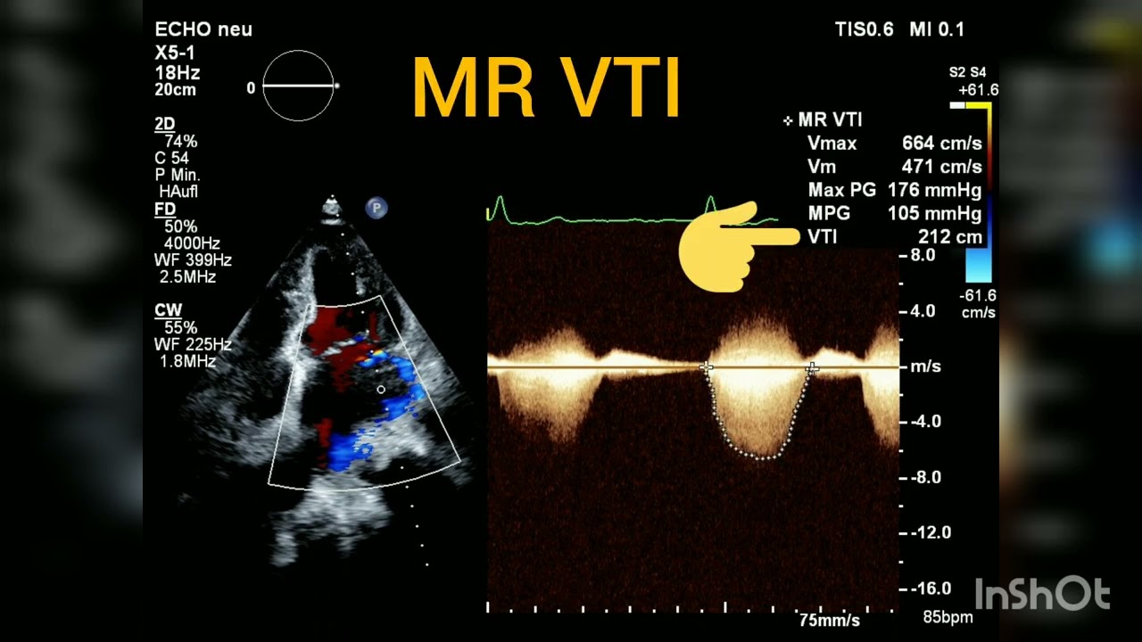 How to quantify Mitral regurgitation with PISA method?
