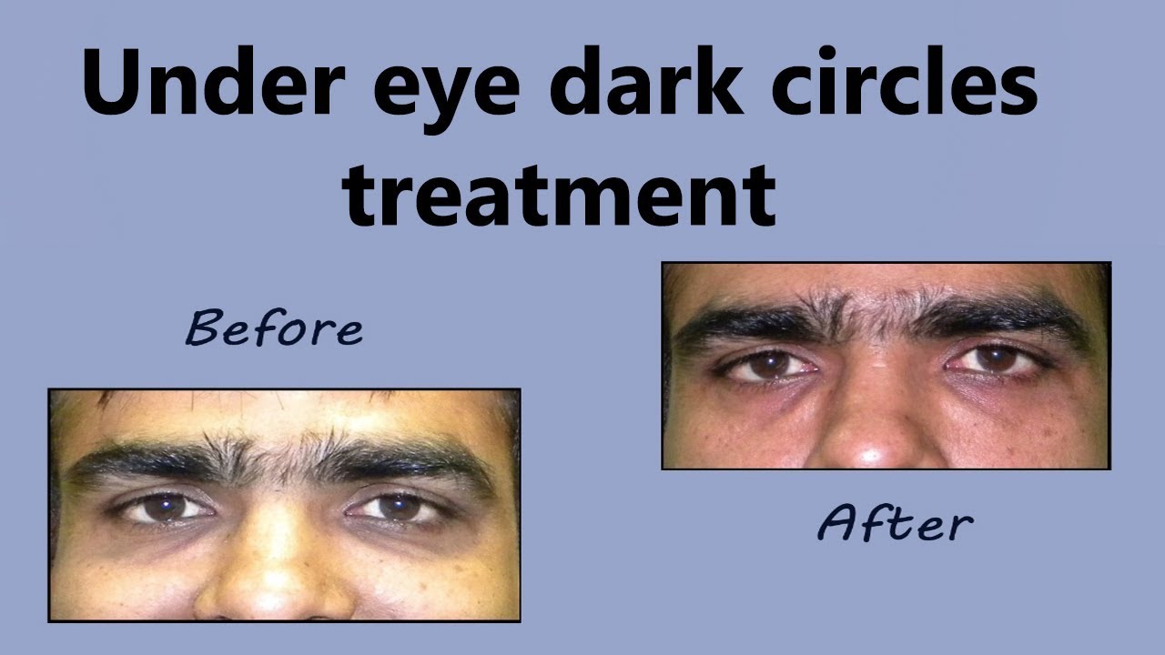 Under Eye Dark Circles Treatment | Laser Pigmentation Removal | Dr. Rinky Kapoor