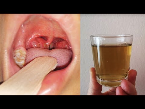 KILLS Throat Pain and Inflammation in 1 Day! 2 simple and very effective recipes! 3 ingredients