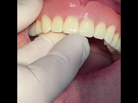 Snap on Dentures