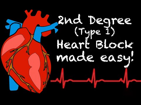 EMS Cardiology || Tachy Tuesday: 2nd Degree Type I Heart Block (Wenckebach)