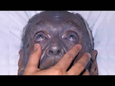 25 Truly BIZARRE Diseases Science Can't Explain