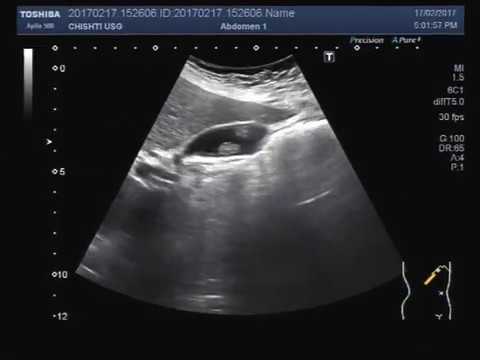 Ultrasound Video showing two Sludge Balls in the Gall Bladder.