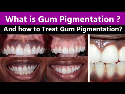 What is Gum Pigmentation ? And how to Treat Gum Pigmentation? – Dr ...