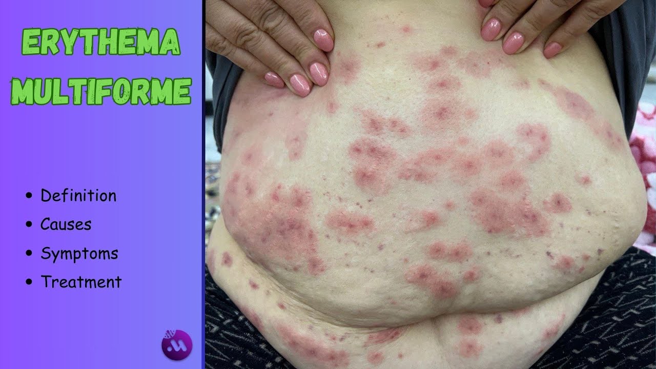 Erythema multiforme - Target-shaped lesions | All you need to know