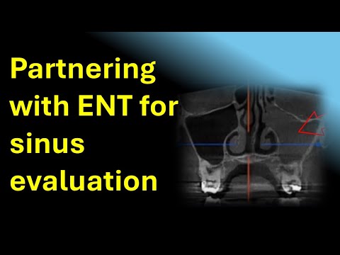 Using the dental cone beam to partner with an ENT in a sinus evaluation