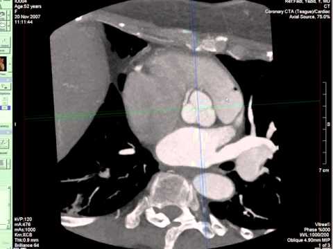 Coronary CT Angiography: Anomalous RCA