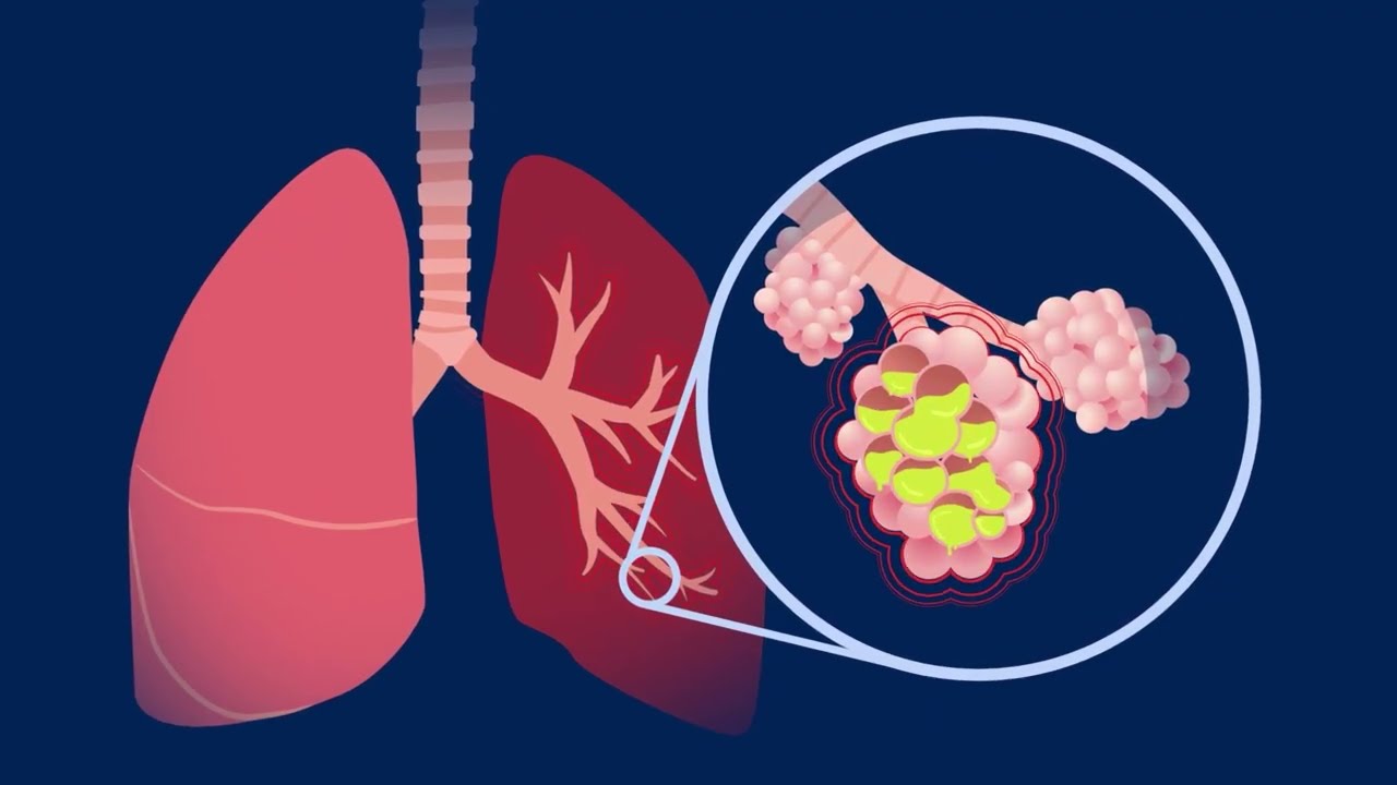 Understanding Pneumococcal Pneumonia