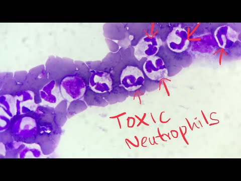 Neutrophilia left shift , grading and prognosis