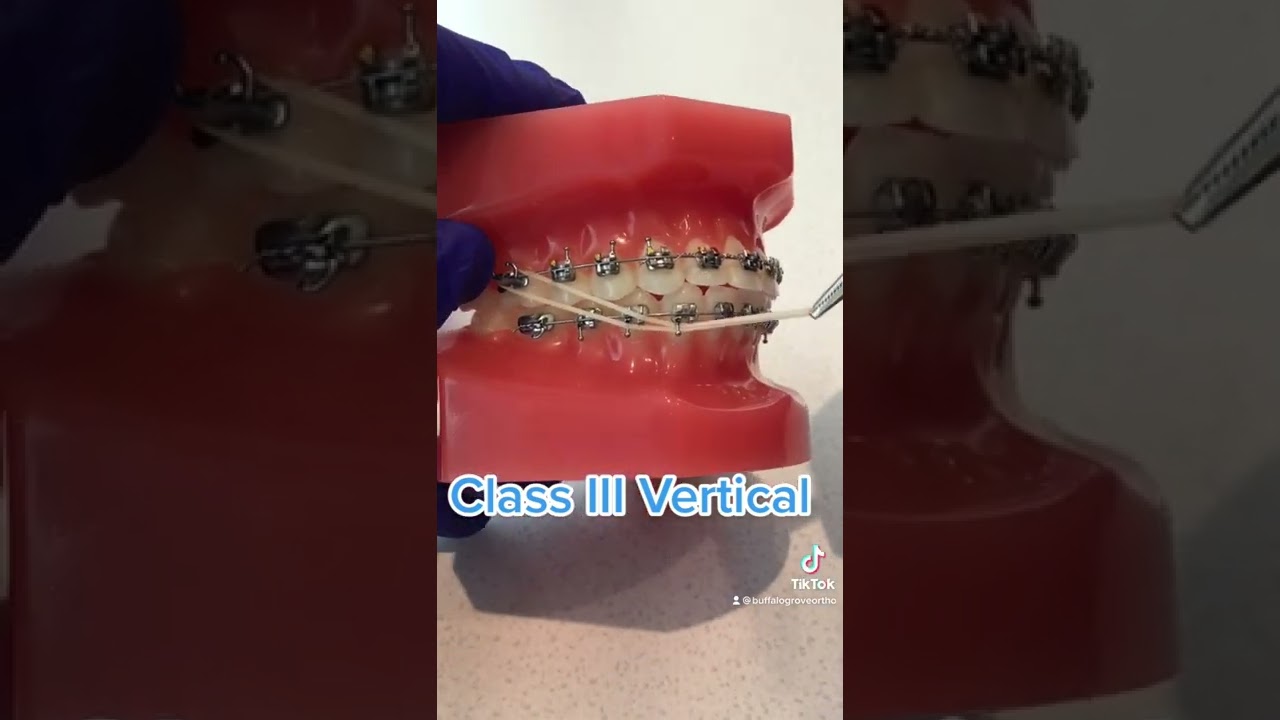 Class III Vertical Rubber Bands