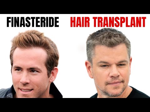 Regaining Hairline with Finasteride vs Hair Transplant! Pros and Cons