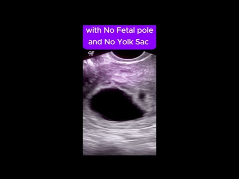 29mm Gestational Sac - No Fetal Pole - Missed Miscarriage