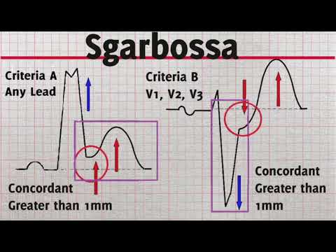 Current ECG Ep 4   Sgarbossa Criteria   STEMI LBBB