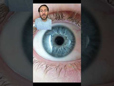Iridology 101, The Lymphatic Iris