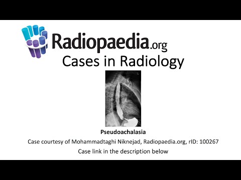 Pseudoachalasia (Radiopaedia.org) Cases in Radiology