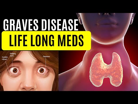 Can Graves' Disease Be Managed Without Lifelong Meds? Discover the Natural Approach!