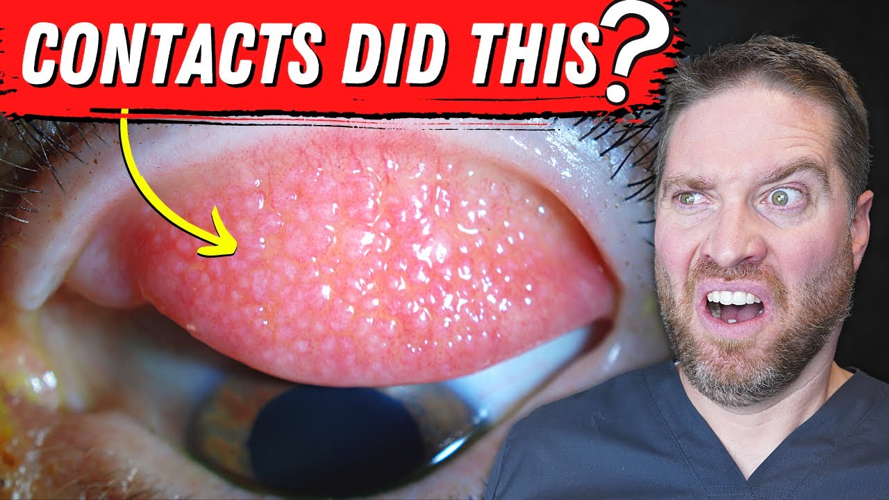What Is GIANT Papillary Conjunctivitis? - 3 Tips To PREVENT It