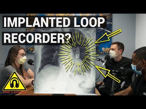 Implantable Loop recorders discussed. What it is and what can happen when placed in a MRI Machine.