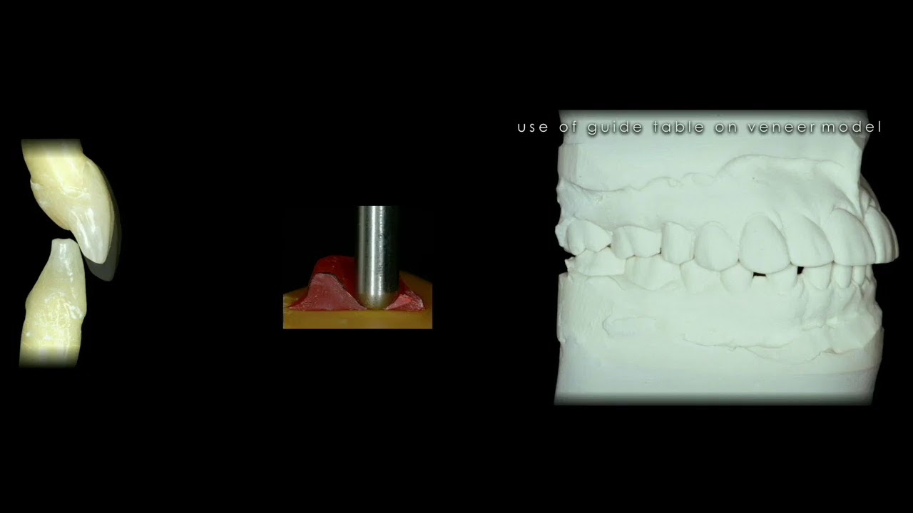 Understanding Edge-to-Edge Occlusion: Insights from the Treating the ...