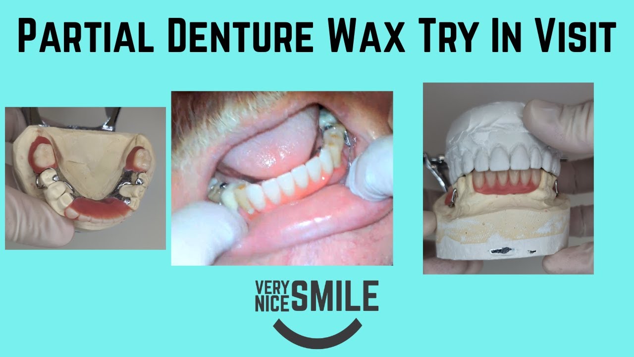 Lower cast metal partial denture wax try in