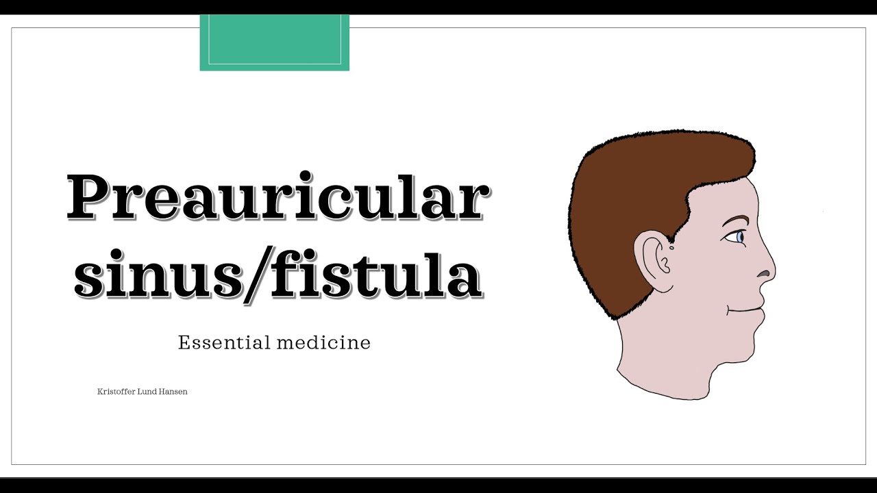 Preauricular sinus/fistula [Essential medicine]