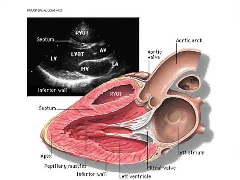 2decho- Screening for HCM