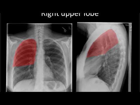 Lobar cxr anatomy