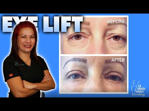 Thinking About An Eye Lift? Real Patient Case Study.