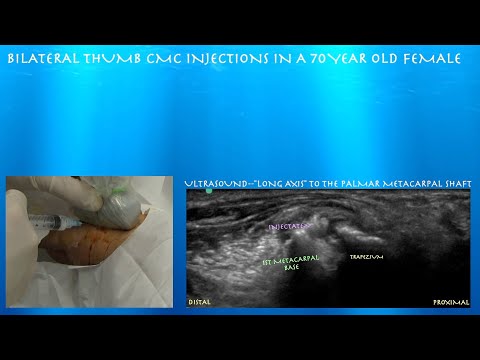 Ultrasound Guided Thumb CMC Joint Injection by probeultrasound.com