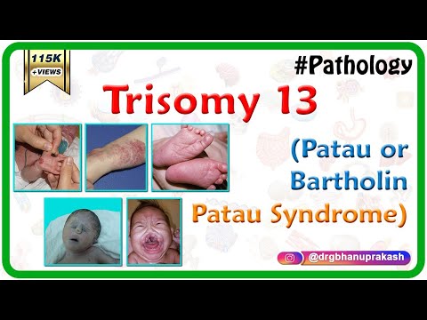 Trisomy 13 (Patau or Bartholin-Patau syndrome) - Causes , Diagnosis , Treatment