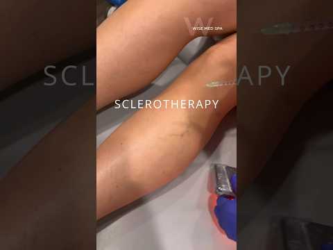 Permanently remove leg veins commonly known as spider veins with Sclerotherapy!