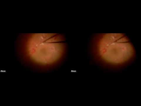 Murtaza Adam, MD: 3D PDR ILM Peel