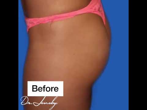 BBL Surgery Before and After Photos